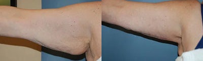 Arm Lift Before & After Pictures - RealSelf