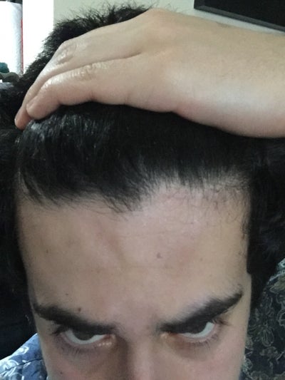 Am I Starting To Show Signs Of A Receding Hairline Or Premature Balding Photo Doctor Answers