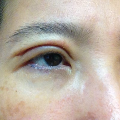 35 days post op upper eyelid surgery, eyelid swelling like sausage ...