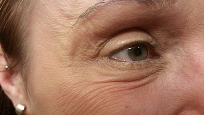 How to get rid of wrinkles on cheeks and around eyes? (Photo) Doctor ...