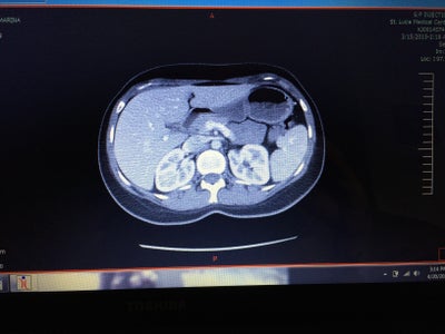 Based on these ct photos, do I have a hernia, diastasis recti or both ...