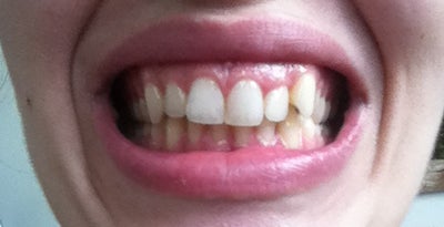 Orthodontics to Fix Single Protruding Tooth? (photo) Dentist Answers, Tips