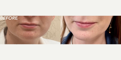 Sylfirm X Before & After Pictures - RealSelf