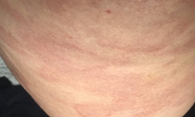 Has anyone else used Prreze Pityriasis Rosea relief cream? - Laser...