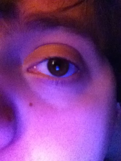 How Can I Correct Bug Eyes? (photo) Doctor Answers, Tips