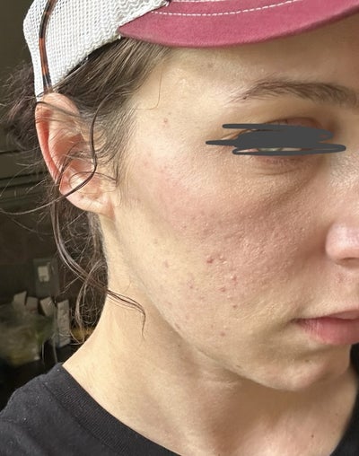 Undereye and Crowsfeet Botox gave me bags and cheek drop - Botox forum