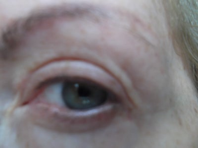 I have an excessive skin above scar line after bilateral upper eyelid ...