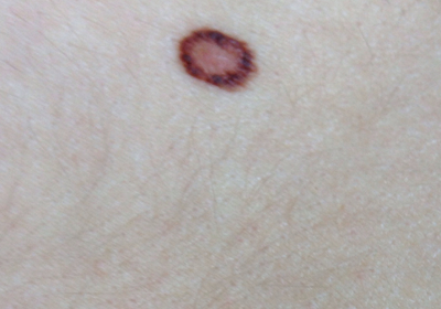 I have a mole on my lower back with a dark circle around it which is ...