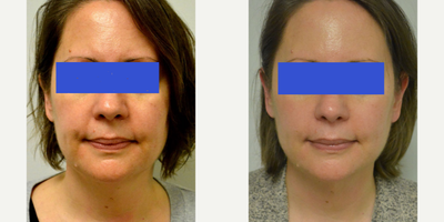 Kybella Before & After Pictures - RealSelf