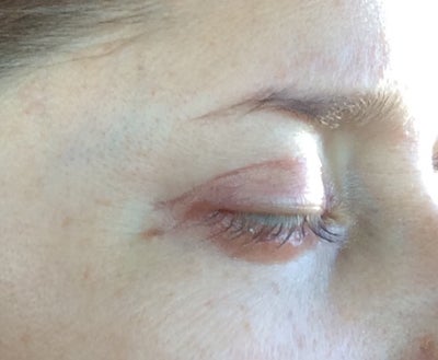 Lagophthalmos 6 wks after upper &lower (transcutaneous) bleph. How ...