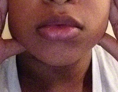 Will Radiesse injections make my round face look square? (photos ...