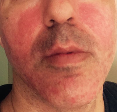 What's the best treatment for removing facial redness caused by Rosacea ...