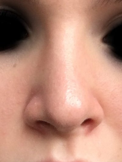 Right nasal bone sticking out, left side of my nose collapsing, crooked ...