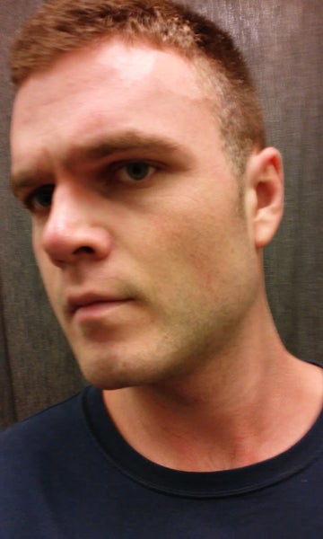 Would implants improve my recessed cheekbones? (Photo) Doctor Answers, Tips