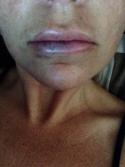 5 days post op Juvederm in my lips. Should I be concerned about ...