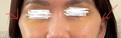 'Swollen' upper cheekbone (left and right) after facial lift & fft...