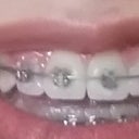 Porcelain Crown Vs Porcelain Veneers for Peg Laterals After Braces ...