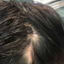 Should I fix scalp calcification or fibrosis before hair transplant ...