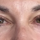 Appearance of dent on outer side of right eye after, Face lift plus ...