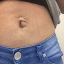 Umbilicoplasty After Umbilical Hernia Repair? (photo) Doctor Answers, Tips