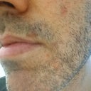 How Can I Get Rid of Skin Rippling? Doctor Answers, Tips