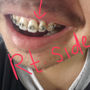 Black Triangle Solution? Now in Braces Treatment...HELP? (photo ...