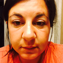 Please help! Is this eye bags, malar mounds, festoons, tear troughs ...