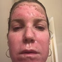 Post Halo blistering / rash. Can I put anything on it to help them go ...