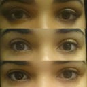 How Much Does Botox Cost for Strabismus? Doctor Answers, Tips