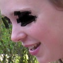 How to prevent 'pinching' and deep supra alar crease lines in Ethnic ...