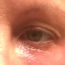 Red Marks Under Eyes After CO2 Laser and Healing, Is This Normal ...