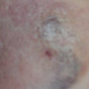 Subcision Suction Method - Plano, TX - Review - RealSelf