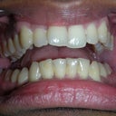 Correcting 8mm Anterior Overjet with Increased Overbite with Invisalign ...