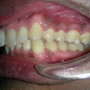 Correcting 8mm Anterior Overjet with Increased Overbite with Invisalign ...