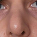 Open Roof Deformity? (photo) Doctor Answers, Tips