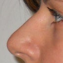 Open Roof Deformity? (photo) Doctor Answers, Tips