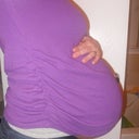 Tummy Tuck with Hernia and Diastasis Repair with "Fleur De Lis" or ...