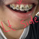 Black Triangle Solution? Now in Braces Treatment...HELP? (photo ...