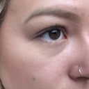 How to Deal With Mild Overcrowding of Teeth? (photo) Dentist Answers, Tips