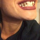 Veneers on VERY Small, Pointy Teeth? (photo) Doctor Answers, Tips