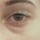 What can be done about under eye creases? Genetic not age related ...