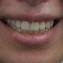 Can this upper dental midline shift be corrected only by veneers ...
