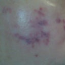 Is Bruising Normal After IPL? Doctor Answers, Tips