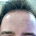 Is dermabrasion the right choice for an indented forehead scar? (photo ...
