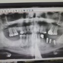 6/18/13 *4 Unit Bridge; Installed on 3 Implants* - Salisbury, MD ...