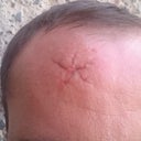 Hypertrophic Scar on Bridge of my Nose - How Can I Get Rid of It ...