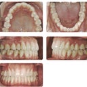 Rotate Canines, Will Invisalign Work? Dentist Answers, Tips