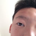 What is causing the dent in my forehead? How can I fix it? (Photo ...