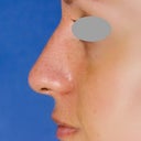 One Sided Inverted V Deformity? or Full Inverted V Deformity? (photo ...