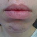Lip Incompetence and Mentalis Strain- Easiest Way to Fix? (photo ...